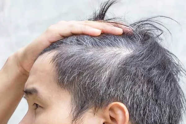 Perhatikan! Ini 4 Penyebab Pemicu Uban di Usia Muda | Prokalteng